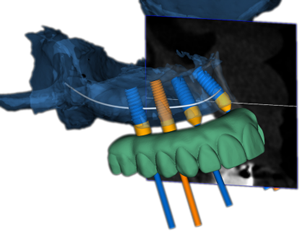 CT Guided Dental Implant Surgery Baltimore, Randallstown, Owings Mills